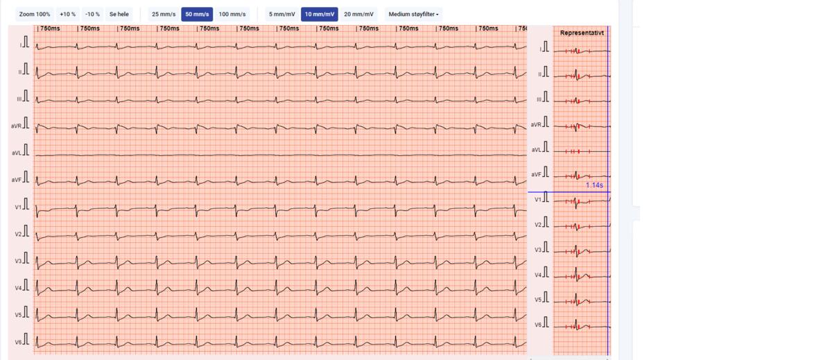 Web EKG – 12-avlednings hvile EKG - Spirare
